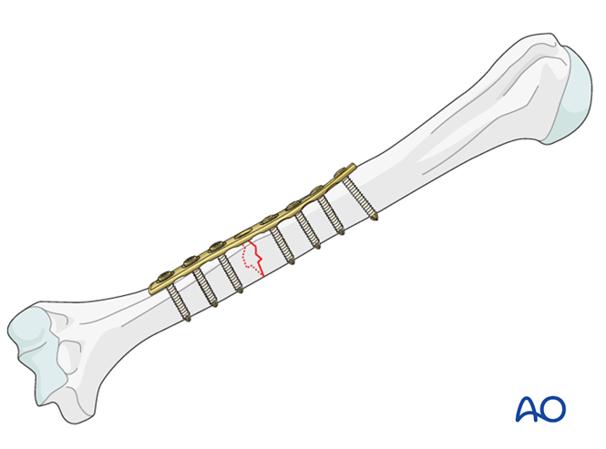 ORIF - Compression plating for Simple fracture, transverse