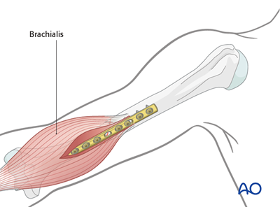ORIF - Compression plating for Simple fracture, oblique