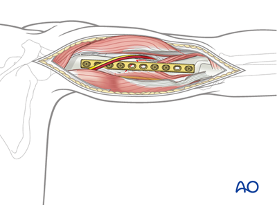 ORIF - Compression plating for Simple fracture, oblique