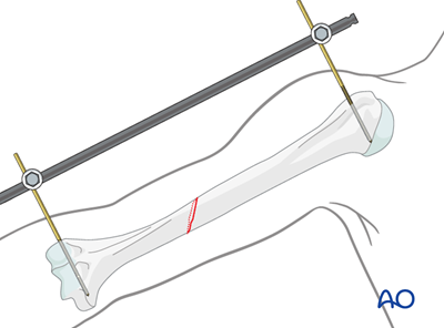 ORIF - Compression plating for Simple fracture, oblique