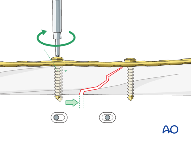 ORIF - Compression plating for Simple fracture, oblique