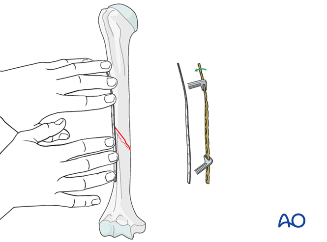 ORIF - Compression plating for Simple fracture, oblique