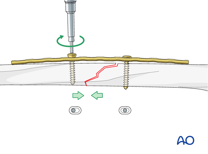 ORIF - Compression plating for Simple fracture, oblique