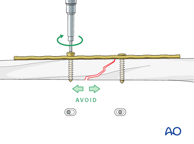 ORIF - Compression plating for Simple fracture, oblique
