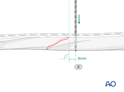 ORIF - Compression plating for Simple fracture, oblique