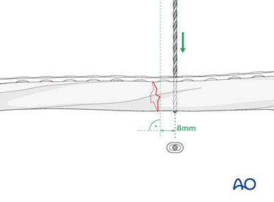 ORIF - Compression plating for Simple fracture, transverse