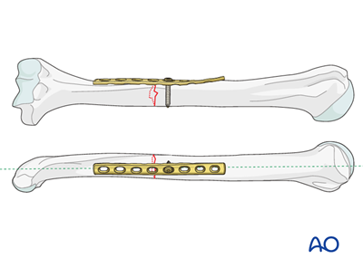 ORIF - Compression plating for Simple fracture, transverse