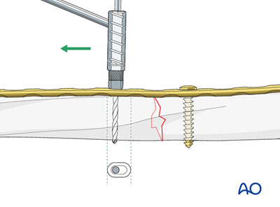 ORIF - Compression plating for Simple fracture, transverse