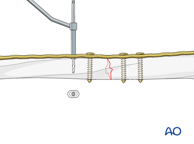 ORIF - Compression plating for Simple fracture, transverse