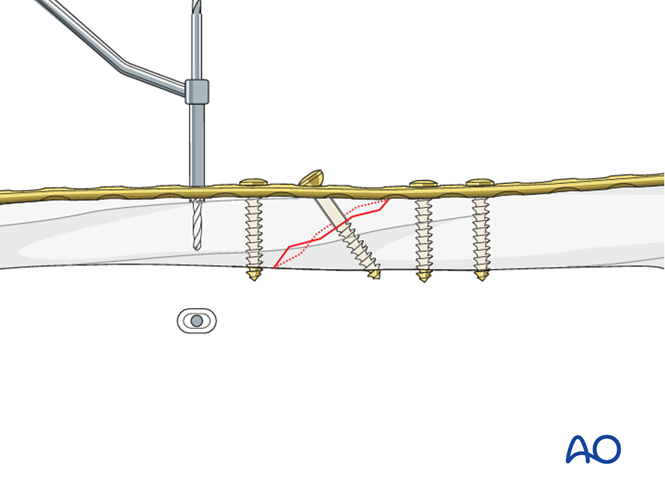 ORIF - Compression plating for Simple fracture, oblique
