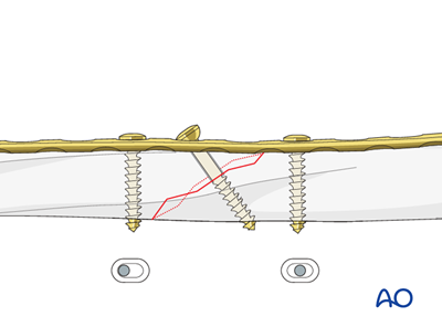 ORIF - Compression plating for Simple fracture, oblique