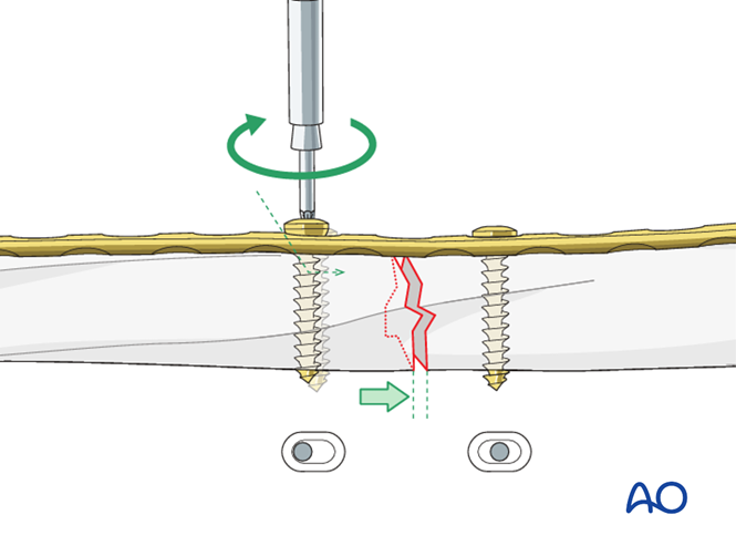 ORIF - Compression plating for Simple fracture, transverse