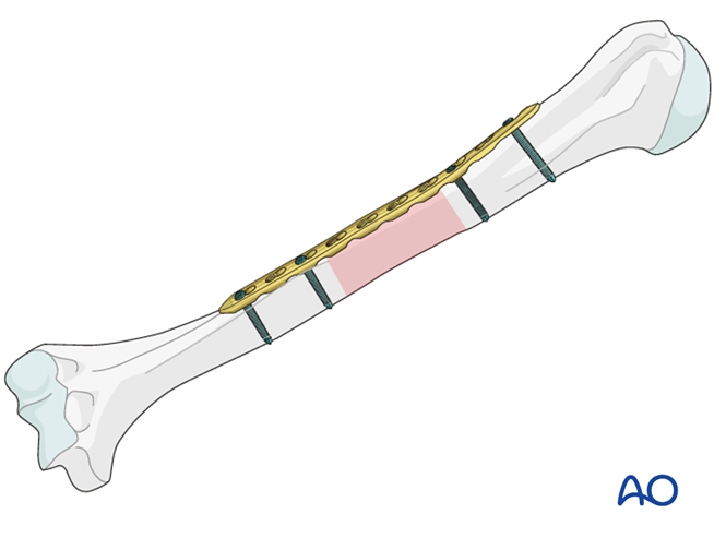 ORIF - Bridge plating (middle 1/3) for Wedge fracture, fragmentary wedge