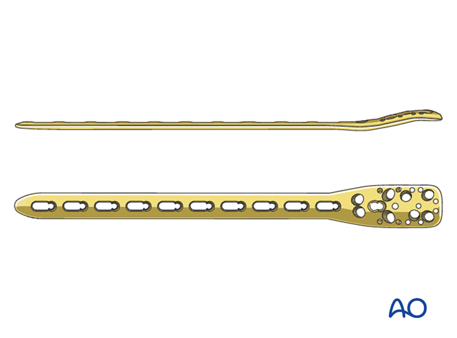 ORIF - Plate fixation (proximal 1/3) for Multifragmentary fracture ...