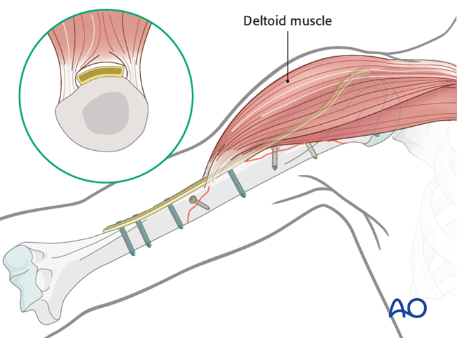 ORIF - Plate fixation (proximal 1/3) for Multifragmentary fracture ...
