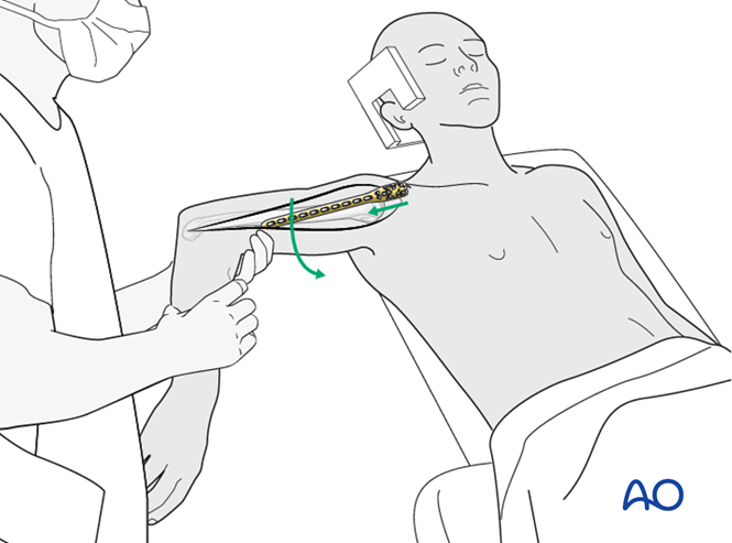 ORIF - Plate fixation (proximal 1/3) for Multifragmentary fracture ...