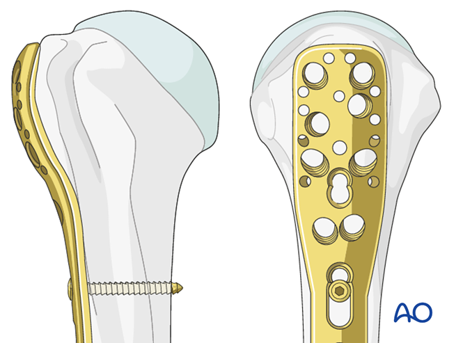 ORIF - Plate fixation (proximal 1/3) for Multifragmentary fracture ...