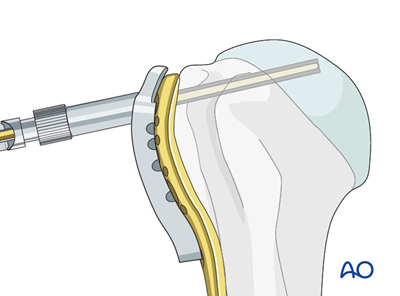 ORIF - Plate fixation (proximal 1/3) for Multifragmentary fracture ...