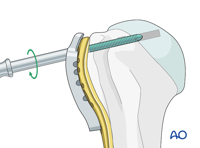 ORIF - Plate fixation (proximal 1/3) for Multifragmentary fracture ...