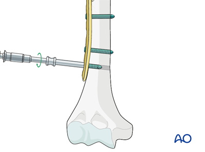 ORIF - Plate fixation (proximal 1/3) for Multifragmentary fracture ...