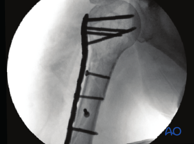 ORIF - Plate fixation (proximal 1/3) for Multifragmentary fracture ...