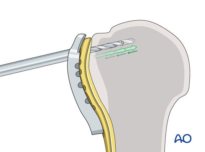 ORIF - Plate fixation (proximal 1/3) for Multifragmentary fracture ...