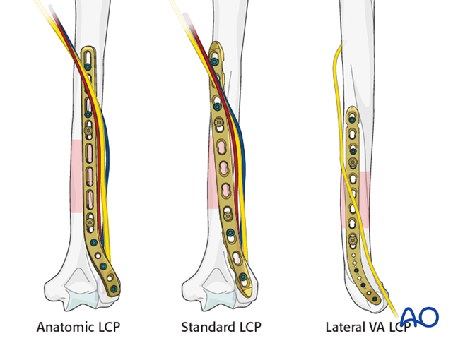 ORIF - Plate fixation (distal 1/3) for Multifragmentary fracture ...