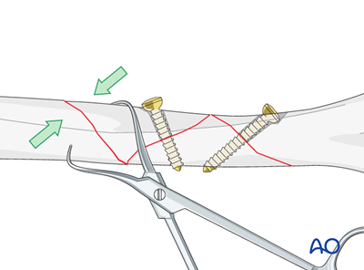 ORIF - Plate fixation (proximal 1/3) for Multifragmentary fracture ...