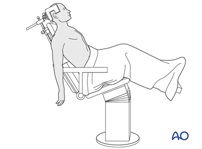 Antegrade nailing - bent nail