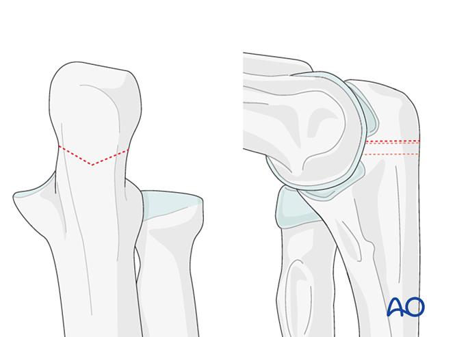 Transolecranon approach to the distal humerus