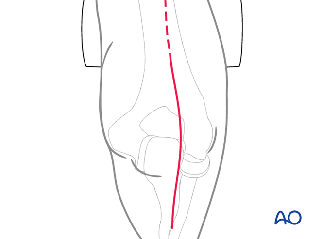 Posterior triceps-elevating approach (after Bryan and Morrey) to the ...