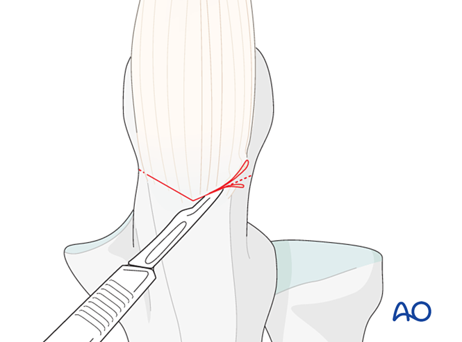 Transolecranon approach to the distal humerus