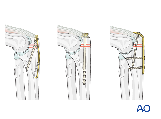 Transolecranon approach to the distal humerus