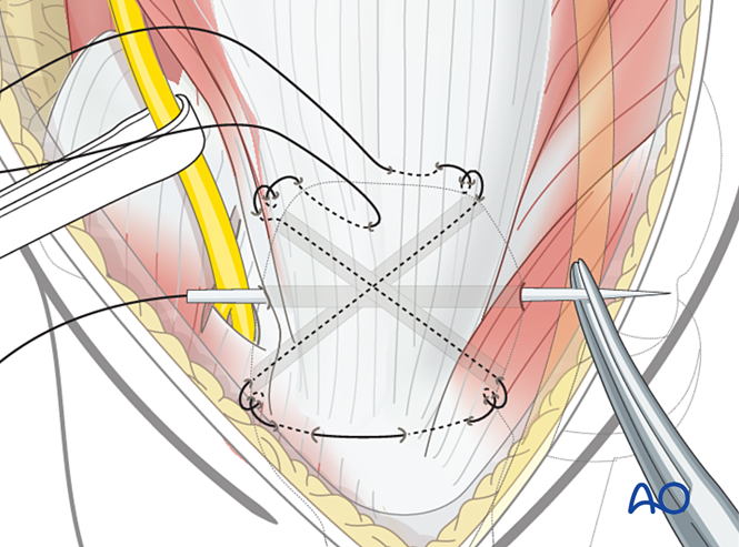 Posterior triceps-elevating approach (after Bryan and Morrey) to the ...