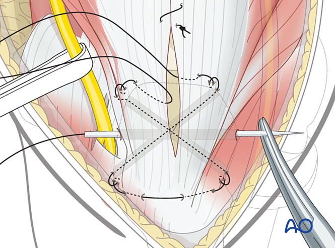 Posterior triceps-split approach (Campbell) to the distal humerus