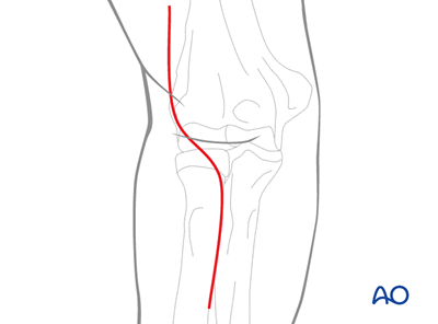 Anterior approach to the capitellum to the distal humerus