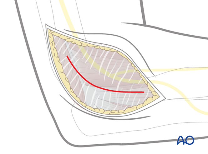Lateral approach to the distal humerus