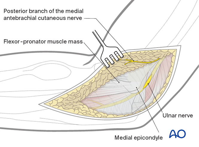 Medial approach to the distal humerus