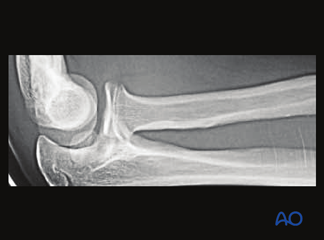 Avulsion of medial epicondyle