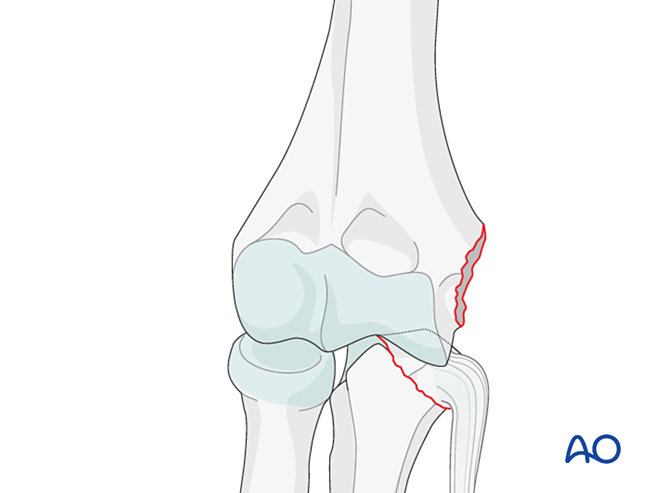 Avulsion of medial epicondyle