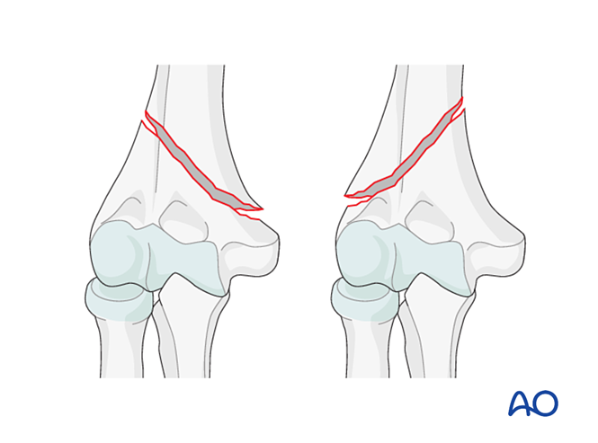 Extraarticular, simple oblique fracture