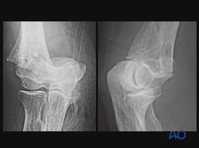 Extraarticular, simple transverse fracture