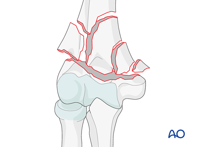 Extraarticular, multifragmentary fracture