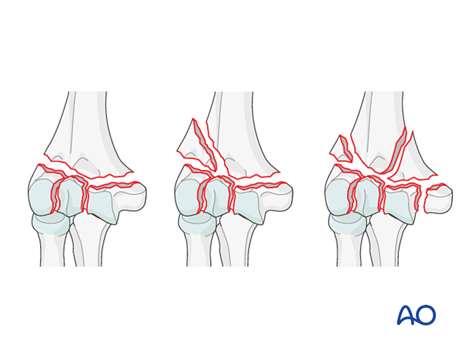 Complete and multifragmentary articular fracture