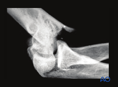 Complete and multifragmentary articular fracture