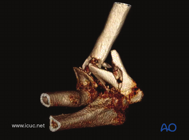 ORIF - Plate fixation for Complete and multifragmentary articular fracture