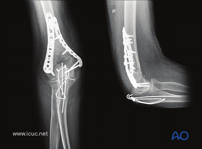 ORIF - Plate fixation for Extraarticular, simple transverse fracture