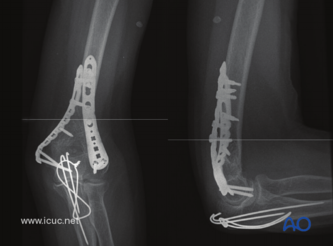 ORIF - Plate fixation for Extraarticular, simple transverse fracture