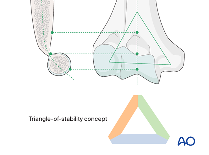 Orif Headless Screw Fixation For Partial Articular Fracture In