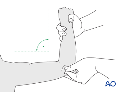 Splint immobilization for Avulsion of lateral epicondyle